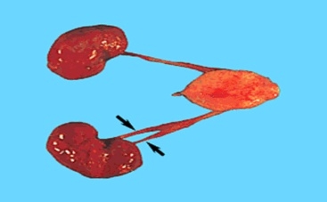 Ureter doble :: Macropatología